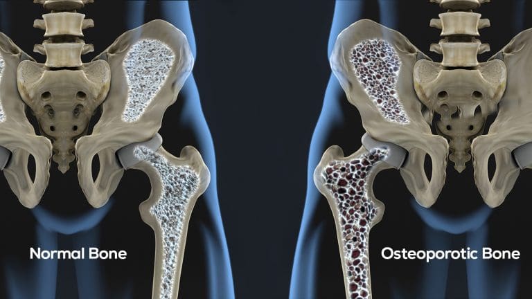 Your Pathway to Stronger Bones | OsteoStrong